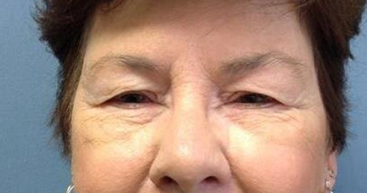 Surgical Face Before & After - Dr. Rudolf Thompson