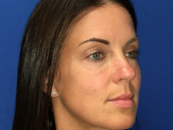 Face Before & After - Dr. Rudolf Thompson