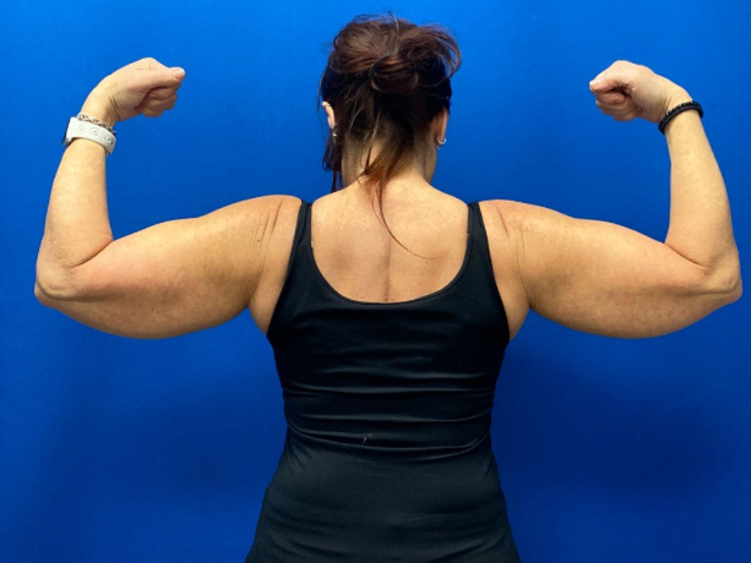Before & After Liposuction Photos - Colts Neck, NJ | Dr. Rudolf Thompson