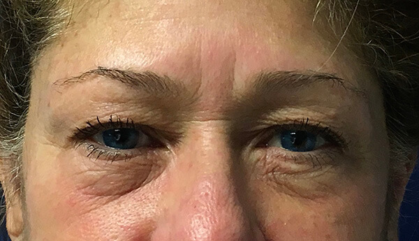 Surgical Face Before & After - Dr. Rudolf Thompson