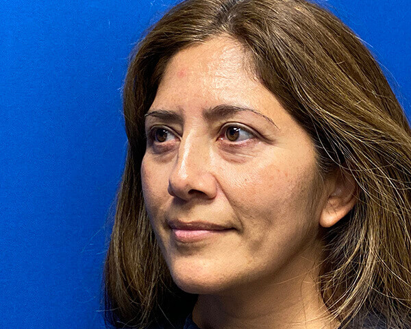 Laser Before & After - Dr. Rudolf Thompson